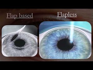 Refractive Surgery Types
