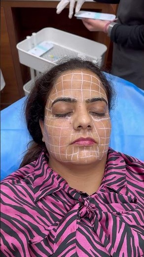 Skin Booster| Juvederm Volite| Best Injector | Summer Skin Booster | Summer Injectable Treatments