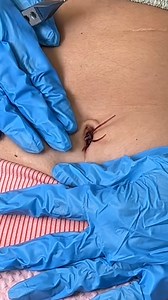 1.8M views · 6.1K reactions | Strange insect removed from belly This original video was produced by Rick Lax and Alex Z. | The Henderson Theater Troupe | Facebook