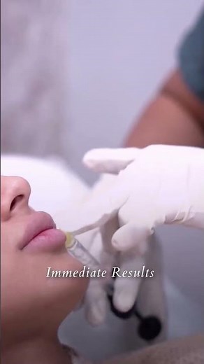 Natural Lip Fillers Explained | Before & After by Dermatologist