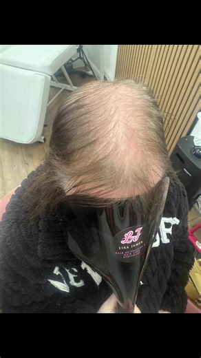 My client came in today for her mesh integration, feeling excited to begin her new hair journey, but also understandably anxious about the unknown. For so long she has avoided simple pleasures — going out for meals, shopping, holidays, and everyday life — because of the constant fear of being stared at, judged, or feeling different. This beautiful lady has been living with female pattern hair loss for some time, with significant progression over the last year. More than anything, she wanted to f