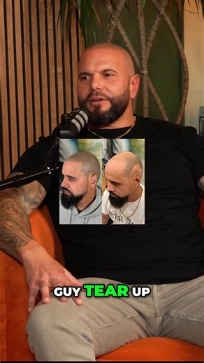 We absolutely love these treatments, they are at the core of why we do this 🙏 @maximum_smp and @thescalpking talk about a client who was a burn victim and wanted SMP to help cover up his scaring and reconstruct his hairline and side profiles. Full episode now on > YouTube #scalpmicropigmentation #scalptattoo #hairtattoo | Scalp Micro USA