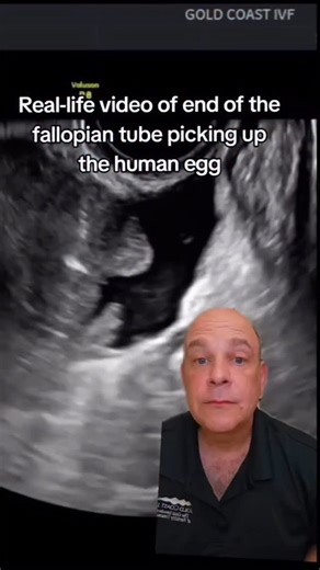 AMAZING LIVE VIDEO #ultrasound images i captured ! the human fallopian tube is NOT attached to the ovary! it hangs by the side and finger like ends called fimbrae pick up the egg let me know in comments if you can feel your eggs ovulate and release ! #infertility #ivf #ttc #life #reels #reel #reelvideos #reelviral #reelvideo #reelsinstagram | Steven Palter