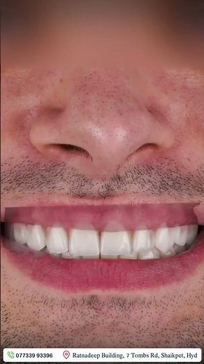 Smile Designing with Veneers | Achieving the Perfect Smile with the Golden Proportion Rule