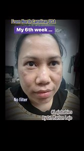 6th week #upperblepharoplasty #rhinoplasty #earcartilage #goretex #chinaugmentation #lajobabies #docmarlonlajo #marlonlajo #LaJo | Marlon O. Lajo