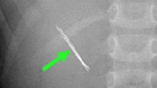 X-Ray Reveals Swallowed Bobby Pin in Boy's Kidney