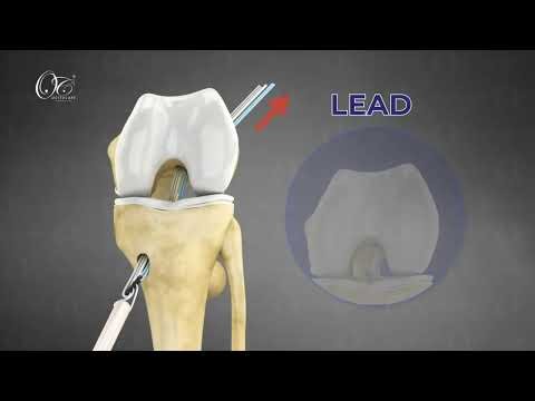 Ecobutton flex ; world first hybrid loop acl femur fixation