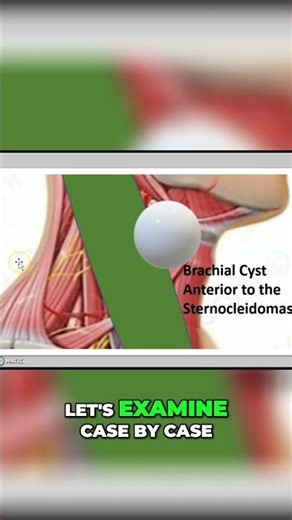 Sternocleidomastoid & Bronchial Cyst: A Quick Anatomy Lesson #shorts