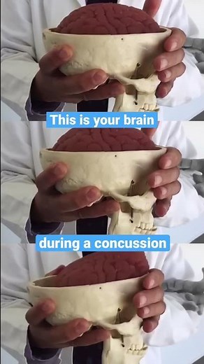 This is your brain during a concussion 😬 🧠 😱
