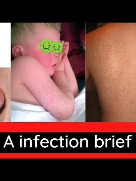 Strep A (Scarlet fever) infection information for patients.