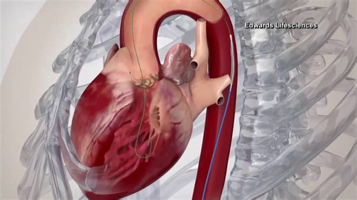 Treating aortic stenosis with a trans aortic valve replacement | Healthwatch 16