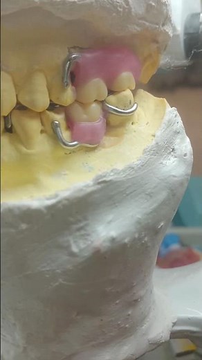 cast partial denture tooth setup #dentist #smiledesigndental #dentalprosthesis