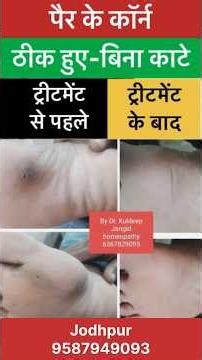 पैरों के कॉर्न हुए ठीक बिना काटे । Corn treatment without surgery#shorts ।