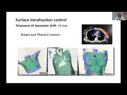 Clinical Implementation of SGRT for lung and liver SBRT in DIBH - using Catalyst HD - C-RAD