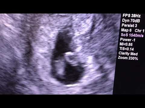 Sonogram: 7 weeks pregnant !