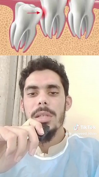 Understanding Wisdom Tooth Problems and Treatments