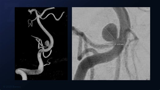 #495: Microsurgical Clipping of an Unruptured Anterior Inferior Cerebellar Artery Aneurysm - All Videos - Seven Series Collection