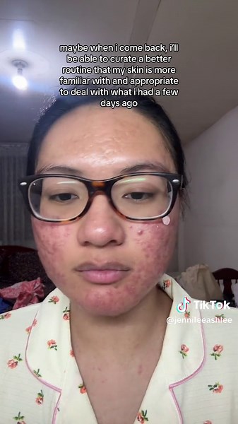 Cystic Acne Skincare Routine Philippines Review