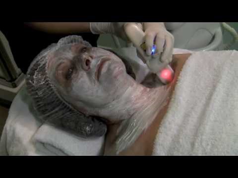 Tratamiento de radiofrecuencia facial