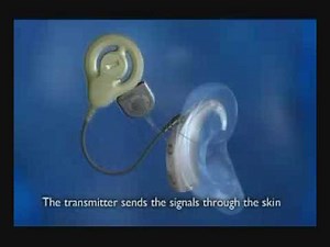 Cochlear Implant and How it works