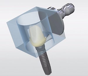 12K views · 16 reactions | CEREC Primescan 5.1 Abutments: The Movie. Step by step walkthrough on an anterior abutment. | DigitalEnamel | Facebook