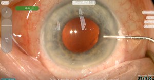 Battle With a Suprachoroidal Hemorrhage - Eyetube