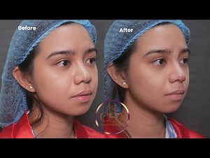 How to do repeat nose thread lift ?