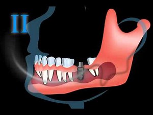 What is Implantation?