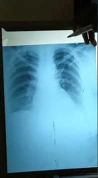 [Radiological Anatomy of the Thorax (Chest X-Ray) part 1] by Aden | Med & Beyond