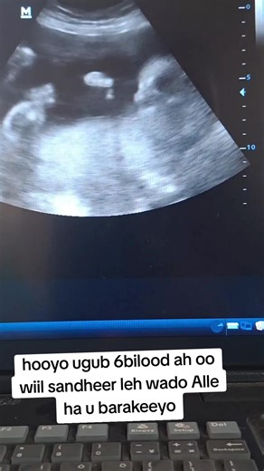 ‏#somalitiktok #qarangeneralhospital #foryou #foryoupage #ultrasound