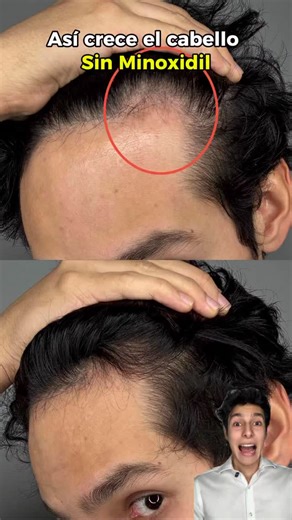 Carlos Raul Morales on Instagram: "Sígueme para más tips ❤️ No es minoxidil. Es la VT PDRN Reedle Shot Hair Ampoule de @vtcosmetics_global Tiene PDRN vegano (ginseng), cafeína y micro-agujas que ayudan a estimular el cuero cabelludo y mejorar la caída con el uso constante. Es un tratamiento cosmético para fortalecer la rutina capilar. ¿La probarías? 👀✨ Lo consigues En Yesstyle con mi código de recompensas: CARLOSSKIN85 #vt #vtcosmetics #hairampoule #hair #hairgrowth"