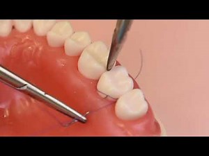 Double Sling Suture Technique