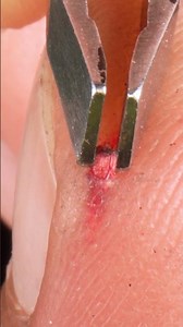 ASMR splinter removal under-skin extraction CLOSE-UP ( macro - zoom in ) #asmr #asmrsounds #closeup