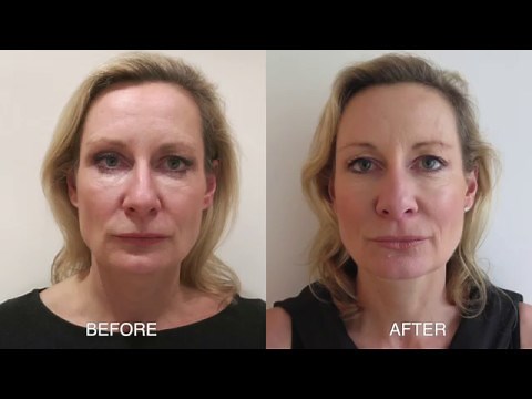 Why I Chose Silhouette Soft Thread Lifting - Patient Testimonial | The Cosmetic Skin Clinic