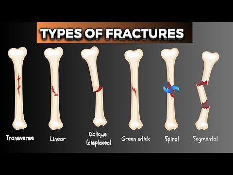 Common Types Of Bone Fractures