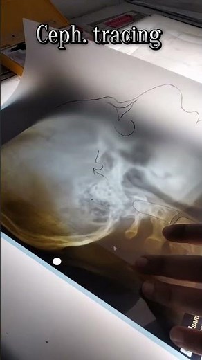 Lateral Cephalometric Tracing #orthodontics #dentistry #cephalometric