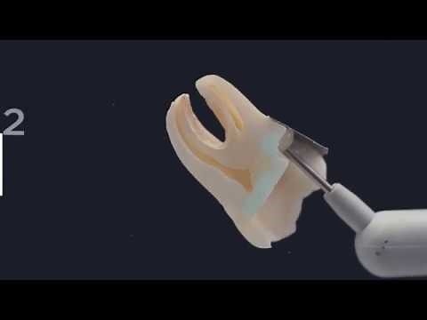 SDR flow+ 10 Year Annniversary | Dentsply Sirona