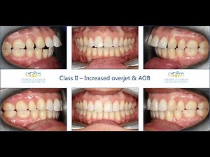 Class II occlusion - Clear aligners & elastics