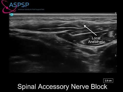 Ultrasound Guided Spinal Accessory Nerve Block