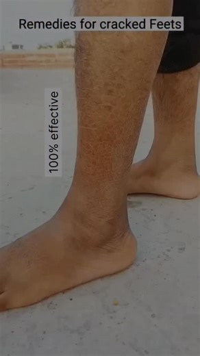 Srush A on Instagram: "Best homeremedy for cracked feet/hand ✅ . . . . . . #cracked #feet #hand #homeremedy #skincare #skincareroutine #trending #viral #crackedfoot #footsmoother #fairfoot #footcream #homeremedy #homemade #natural #naturalcures #skin #skincare #bodycare #body #viral #viralvideos #trend #giftideas #trendingreels #trending #reelsinstagram #reelsvideo #reels #naturalremedies"