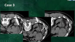 Image-guided Ablation for Renal Cell Cancer: Should You Choose Microwave or Cryoblation? What Ablation Complications Can Be Expected?