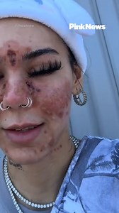 Influencer Beasteater has taken to SnapChat to update fans on her skin after she had to go to hospital for a serious reaction | PinkNews