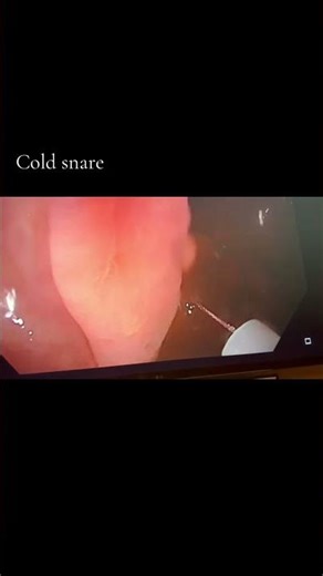 Colonoscopy Footage: Large Polyp Removed#ColonHealth #PreventCancer