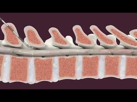 Stimwave SCS Stimulator Placement 63650