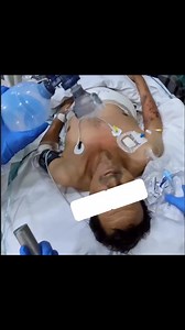 Endotracheal tube (ETT) is a flexible tube that's inserted into a patient's throat to provide oxygen and air to the lungs. | Kamran Ahmad