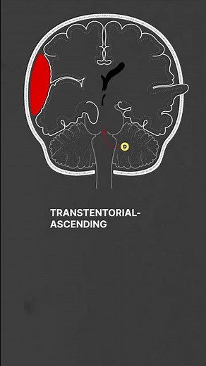 Brain Herniation Syndromes