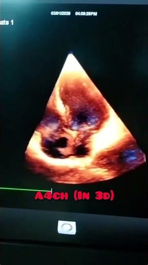 “Four‑chamber flash!Echo window unlocked – LA, LV, RA, RV all in sync.