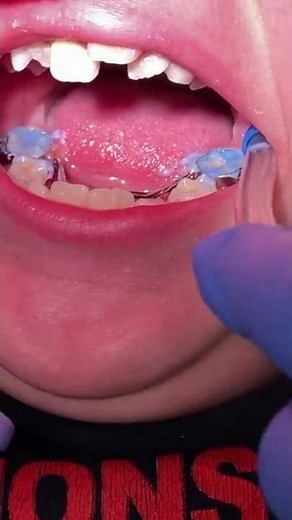 Two Expanders - Upper & Lower RPE - Tooth Time Family Dentistry New Braunfels Texas Braces