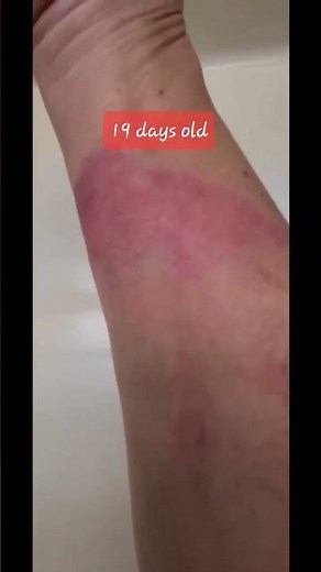 Second degree burn healing process! #burn