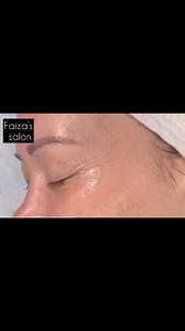 171K views · 18 reactions | Collagen threads to fill wrinkles and facelift. The video shows how the threads dissolve. First, there was a deep cleansing of the face, then a light peeling, and after that a peptide was applied to each zone and a thread on top of it in place of the wrinkle line, after a face massage and a Botox mask. Service available at @faizas.salon Bahria branch Dm us @dr.mahwish_younas for further details and appointments | Faiza's Beauty Salon | Facebook